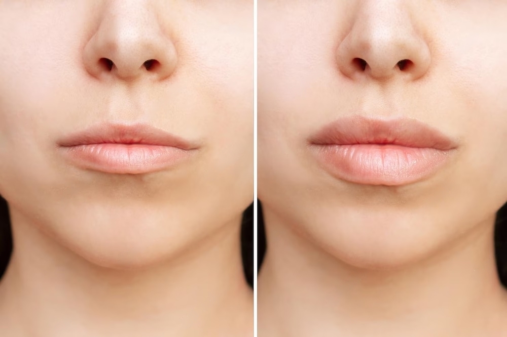 Tout savoir sur l'injection des lèvres : du processus à l'après ...
